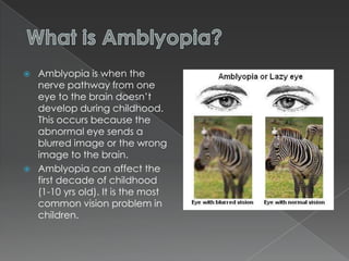 Amblyopia | PPT