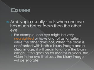 Amblyopia | PPT