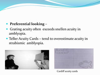 Amblyopia | PPTX