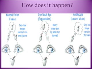 Introduction, Assessment and Management of Amblyopia | PPT