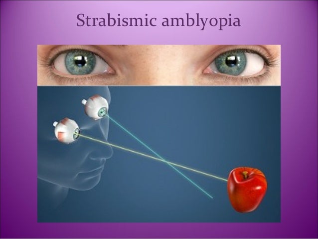 Introduction, Assessment and Management of Amblyopia
