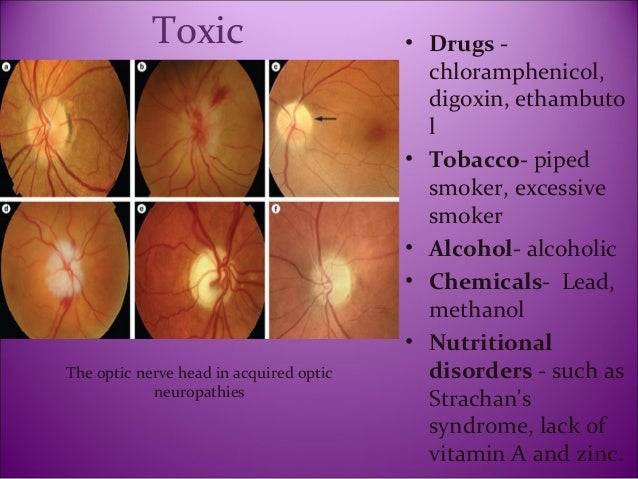 Introduction, Assessment and Management of Amblyopia
