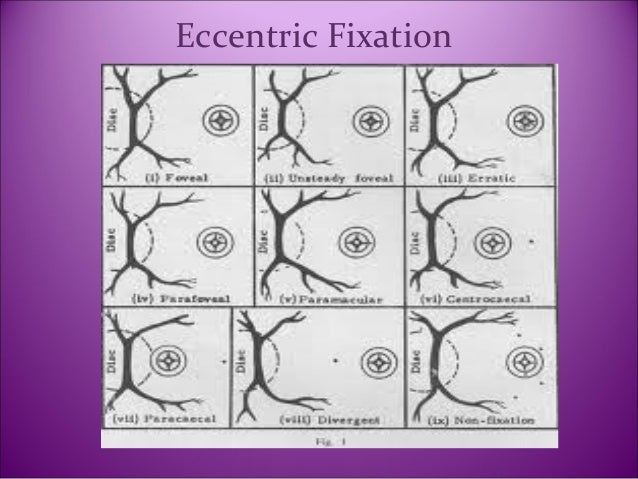 Introduction, Assessment and Management of Amblyopia