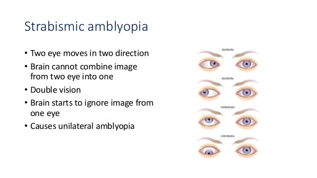 Amblyopia (Understanding the Brain: The Neurobiology of Everyday Life…