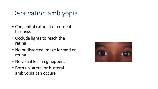 Amblyopia (Understanding the Brain: The Neurobiology of Everyday Life…