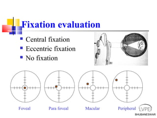 Amblyopia by surendra | PPT | Eye and Vision Conditions | Diseases and ...