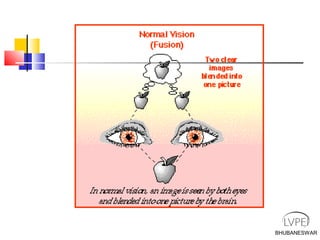 Amblyopia by surendra | PPT | Eye and Vision Conditions | Diseases and ...