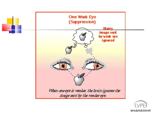 Amblyopia by surendra | PPT | Eye and Vision Conditions | Diseases and ...
