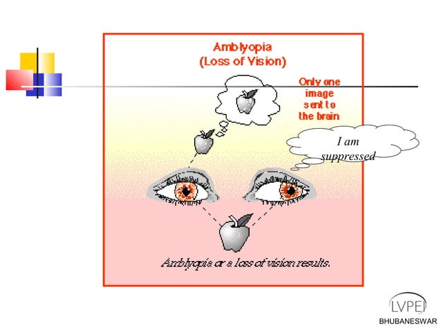 Amblyopia by surendra | PPT | Eye and Vision Conditions | Diseases and Conditions