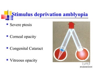 Amblyopia by surendra | PPT | Eye and Vision Conditions | Diseases and ...