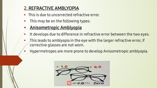 Excercise and Treatment AMBLYOPIA.pdf