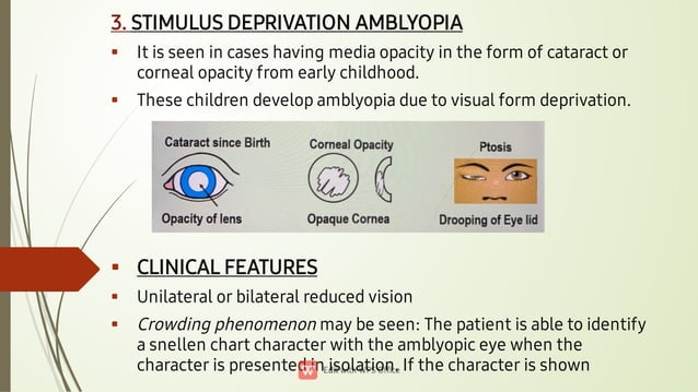 Excercise and Treatment AMBLYOPIA.pdf