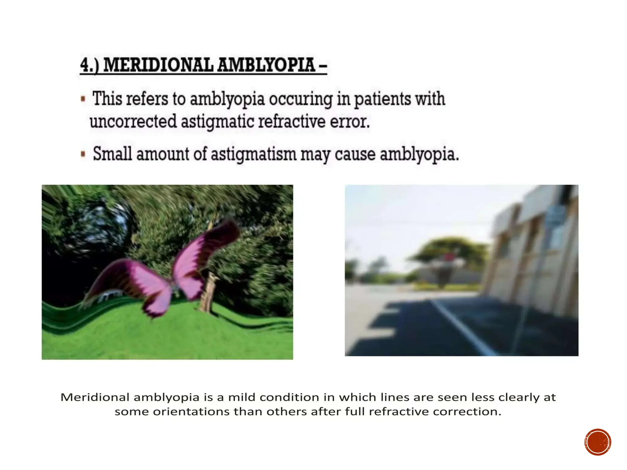 Amblyopia: Definition, classification and Management | PPT