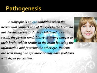 Amblyopia 2 | PPTX
