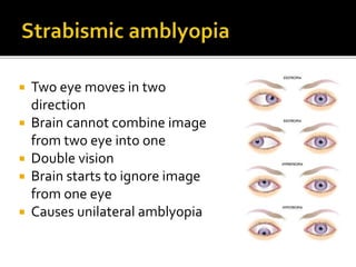 Amblyopia 2 | PPT