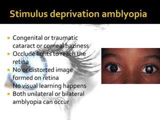 Amblyopia 2 | PPT