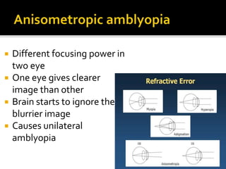 Amblyopia 2 | PPT