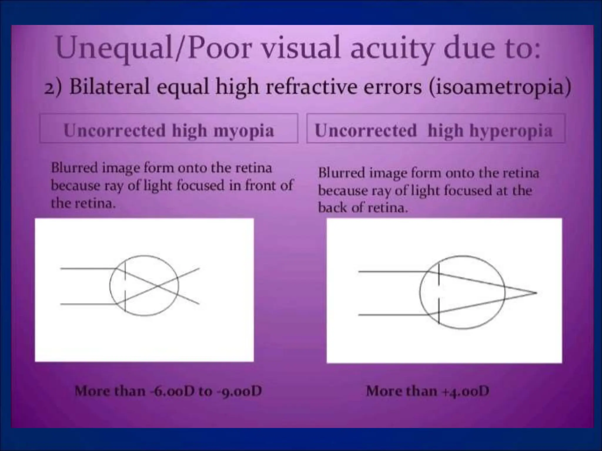 AMBLYOPIA CLASSIFICATION-SQUINT.ppt classification of ambylopia ppt | PPT