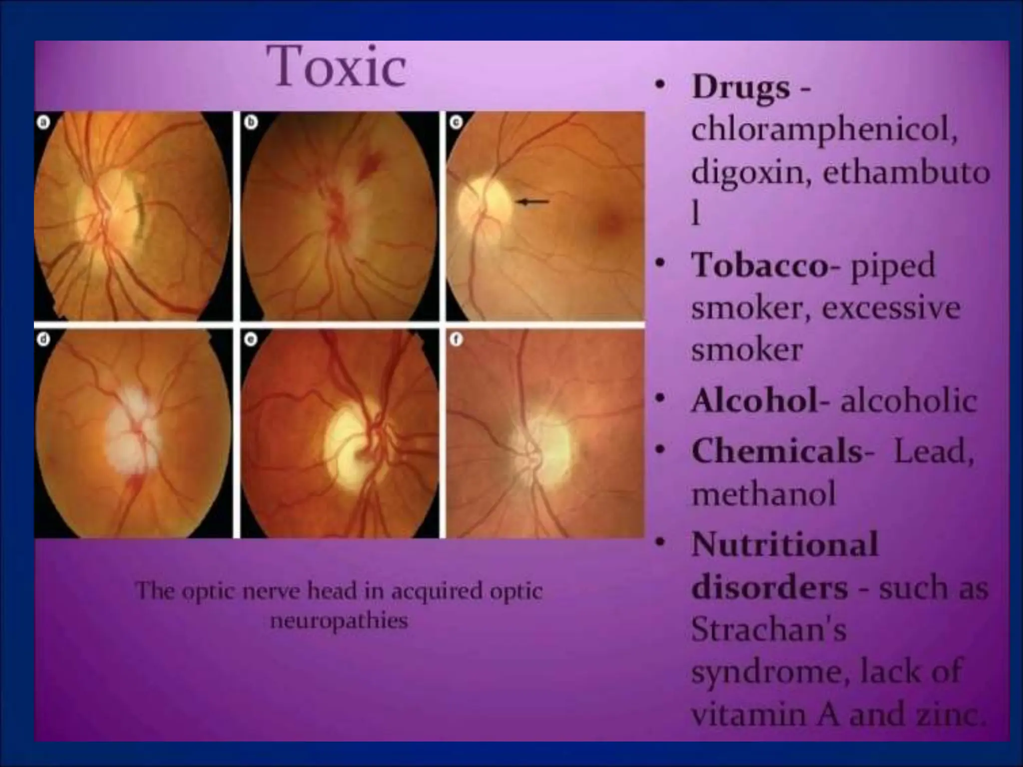 AMBLYOPIA CLASSIFICATION-SQUINT.ppt classification of ambylopia ppt | PPT