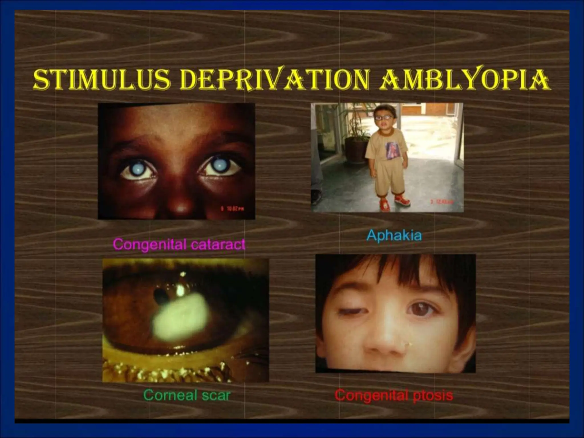AMBLYOPIA CLASSIFICATION-SQUINT.ppt classification of ambylopia ppt | PPT