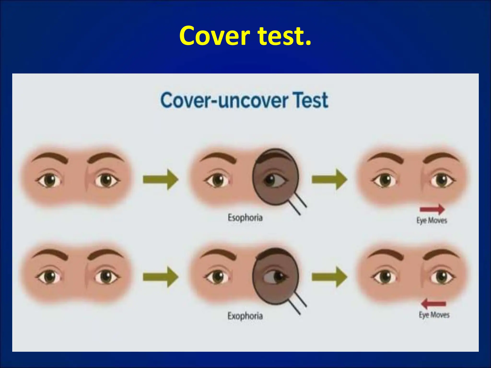 AMBLYOPIA CLASSIFICATION-SQUINT.ppt classification of ambylopia ppt | PPT