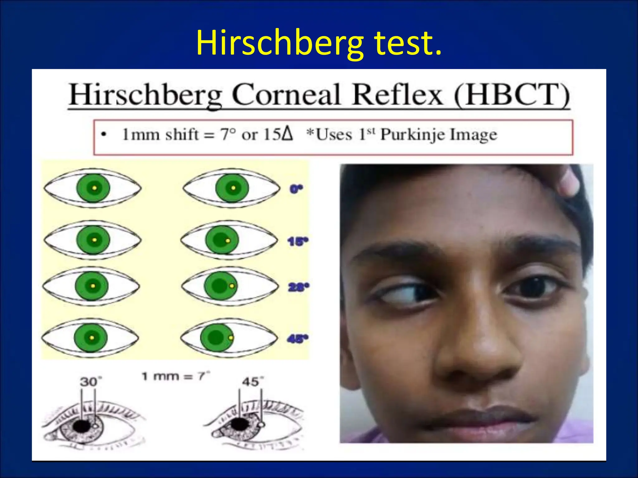 AMBLYOPIA CLASSIFICATION-SQUINT.ppt classification of ambylopia ppt | PPT