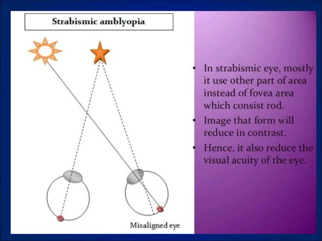 AMBLYOPIA CLASSIFICATION-SQUINT.ppt classification of ambylopia ppt | PPT