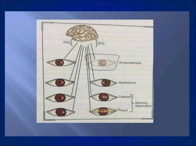 AMBLYOPIA CLASSIFICATION-SQUINT.ppt classification of ambylopia ppt | PPT