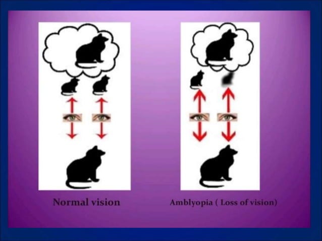 AMBLYOPIA CLASSIFICATION-SQUINT.ppt classification of ambylopia ppt | PPT