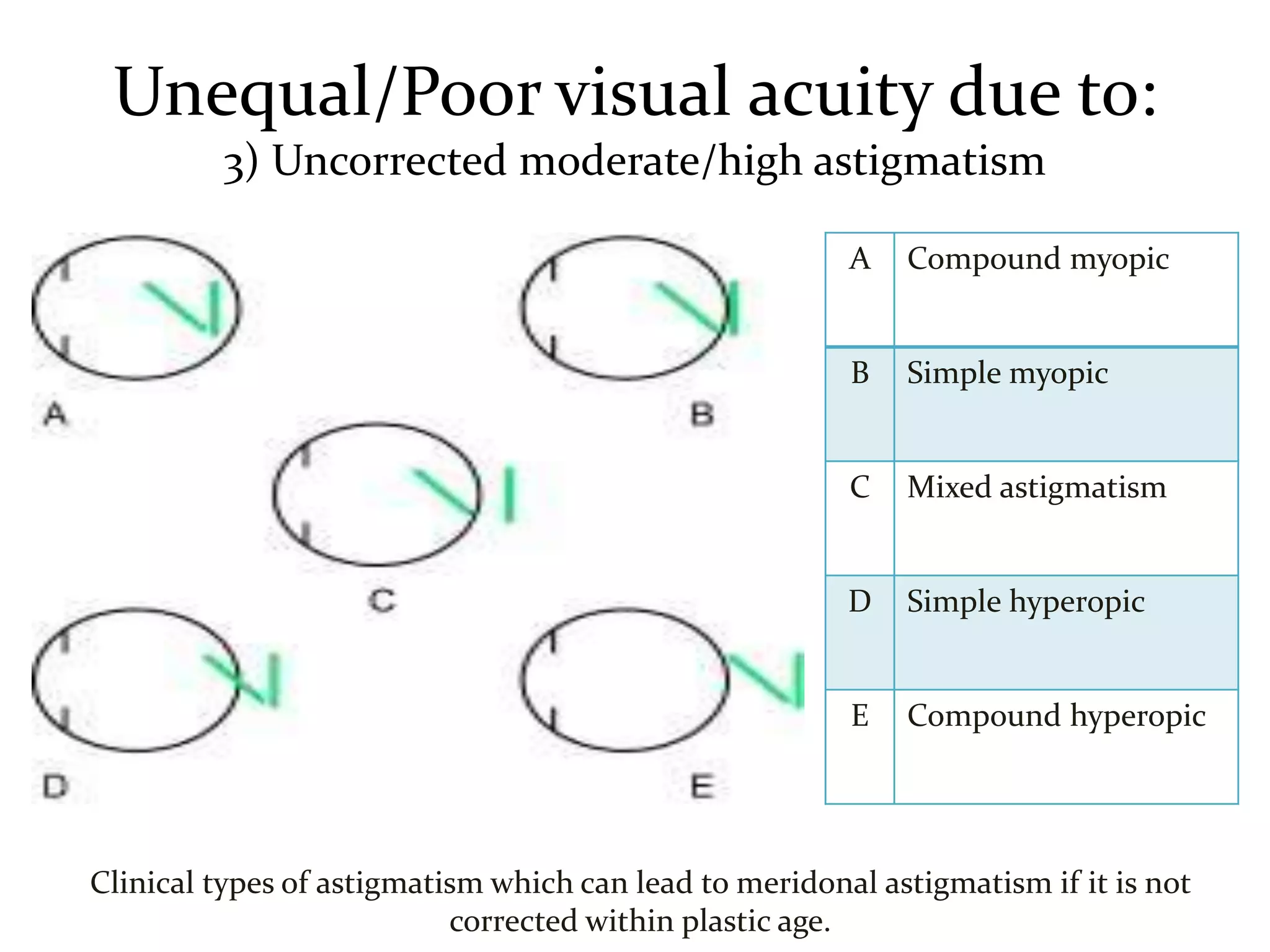 AMBLYOPIA, CLASSIFICATION & MANAGEMENT - Modified.pptx