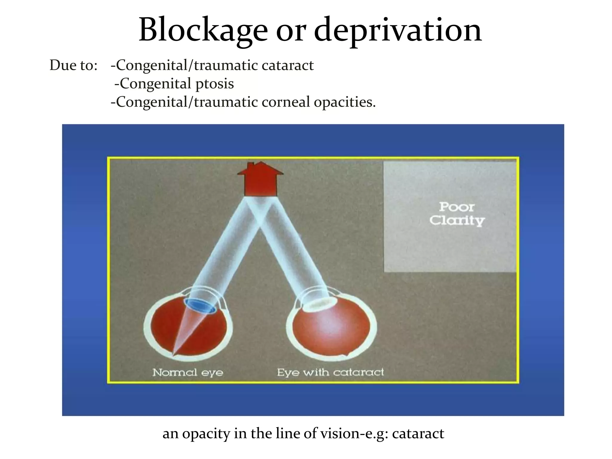 AMBLYOPIA, CLASSIFICATION & MANAGEMENT - Modified.pptx