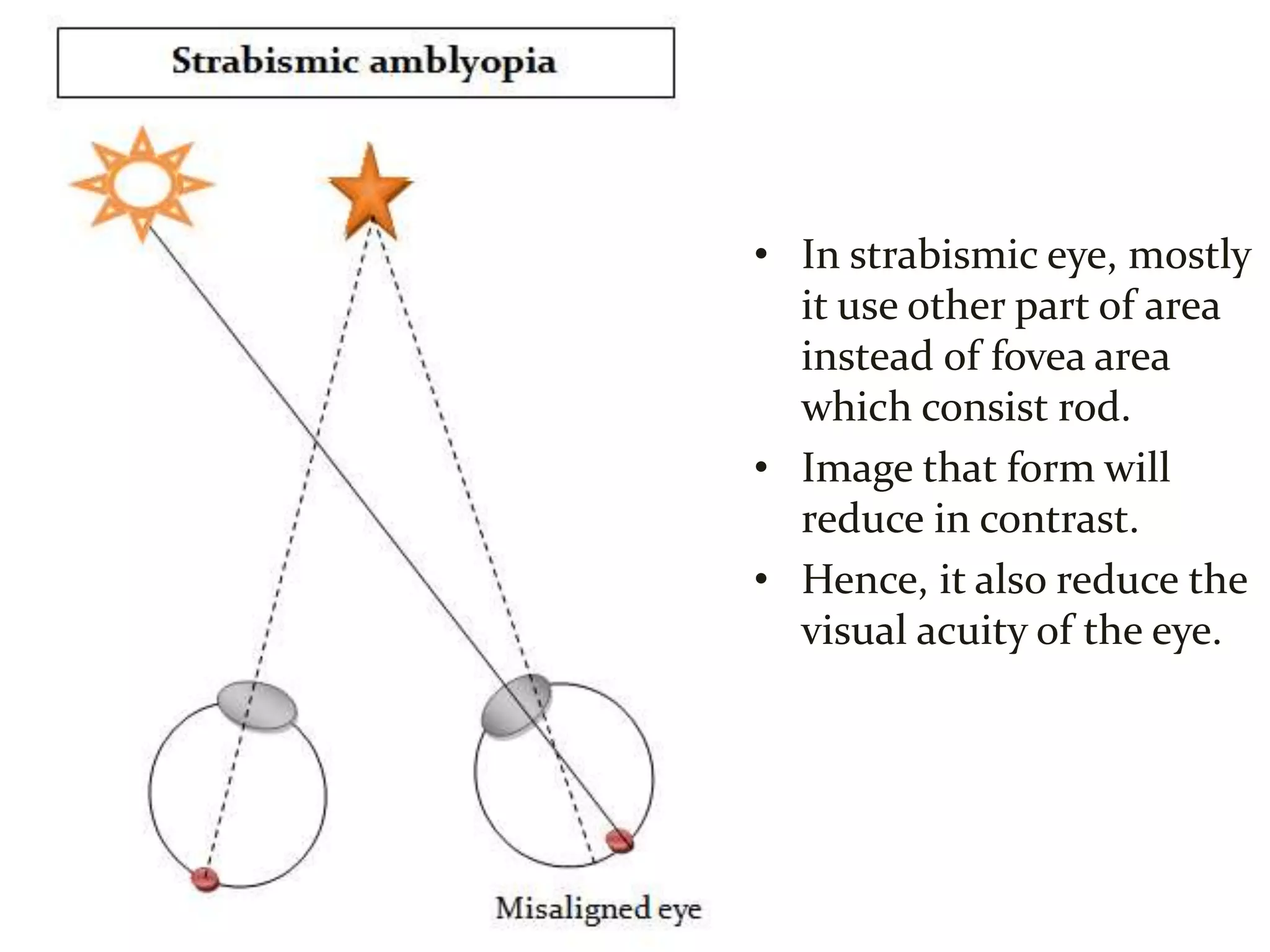 AMBLYOPIA, CLASSIFICATION & MANAGEMENT - Modified.pptx