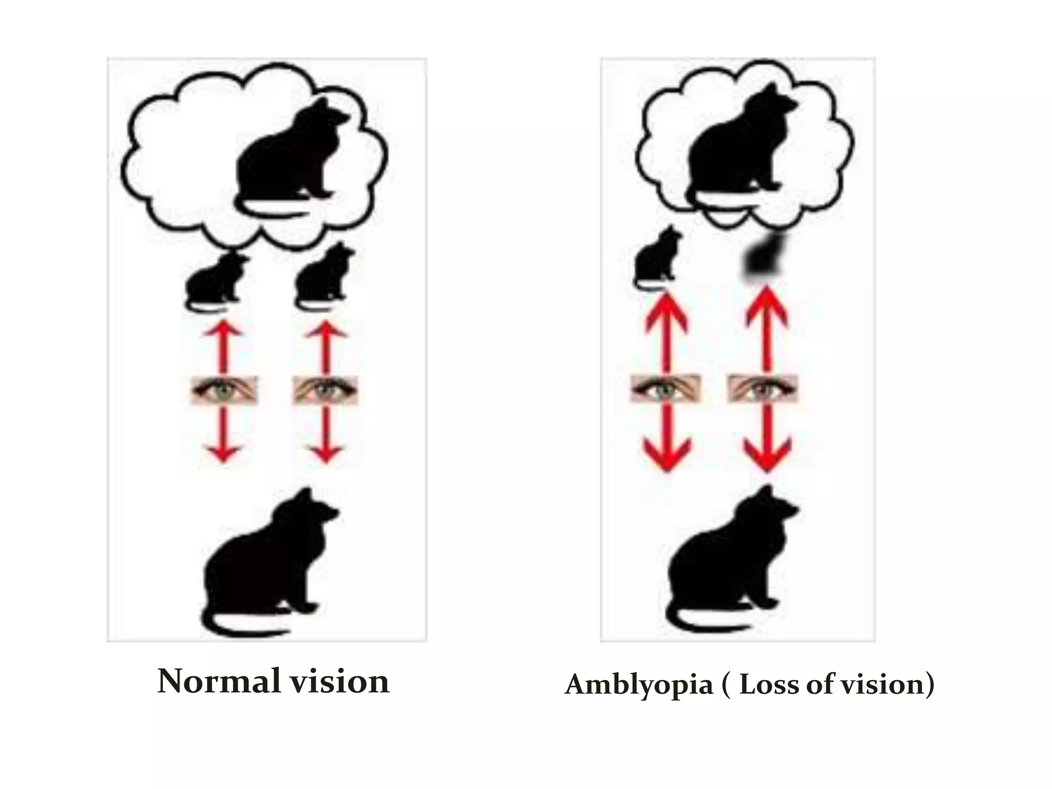 AMBLYOPIA, CLASSIFICATION & MANAGEMENT - Modified.pptx