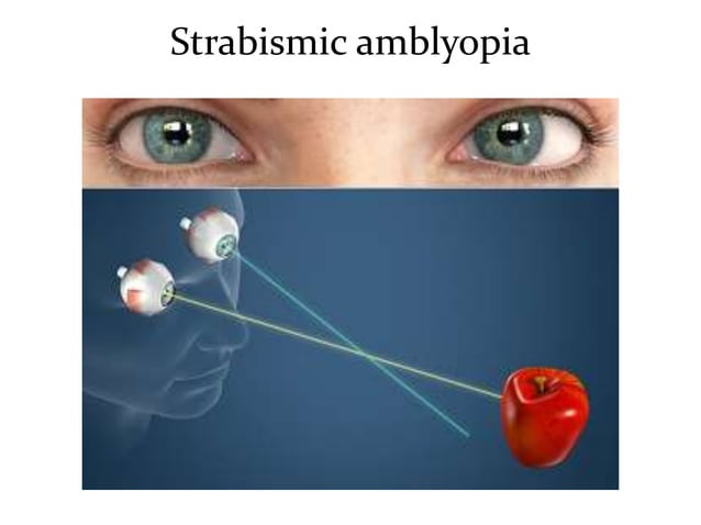AMBLYOPIA, CLASSIFICATION & MANAGEMENT - Modified.pptx
