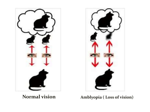 AMBLYOPIA, CLASSIFICATION & MANAGEMENT - Modified.pptx | Free Download