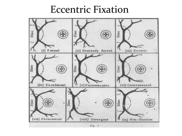 AMBLYOPIA, CLASSIFICATION & MANAGEMENT - Modified.pptx