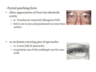AMBLYOPIA, CLASSIFICATION & MANAGEMENT - Modified.pptx