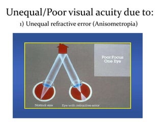 AMBLYOPIA, CLASSIFICATION & MANAGEMENT - Modified.pptx
