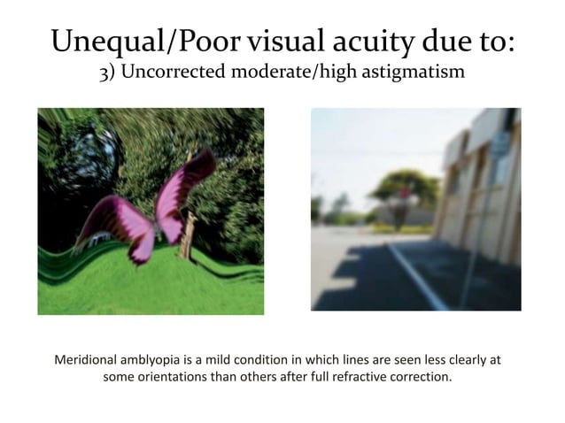 AMBLYOPIA, CLASSIFICATION & MANAGEMENT - Modified.pptx