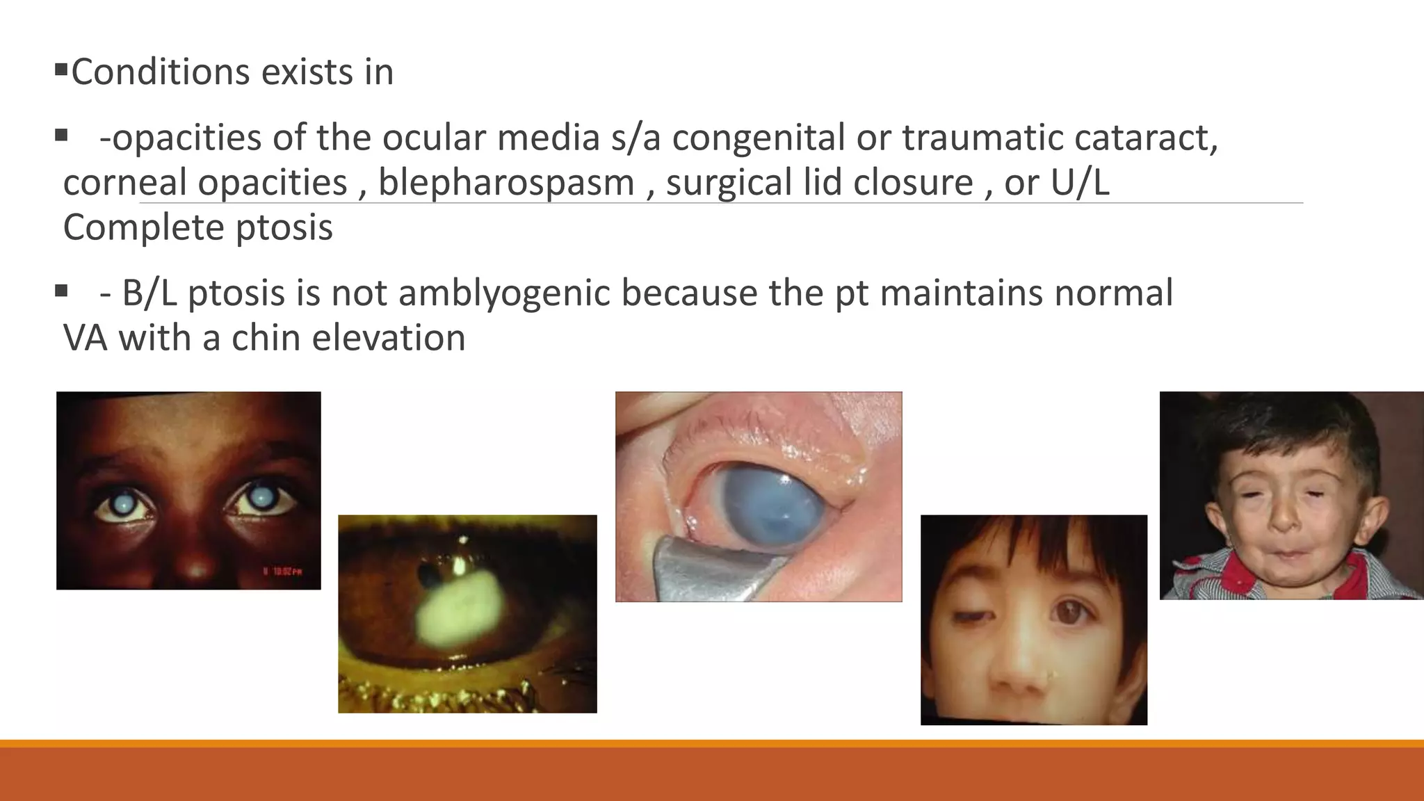 Amblyopia : classification & Occlusion therapy | PPTX