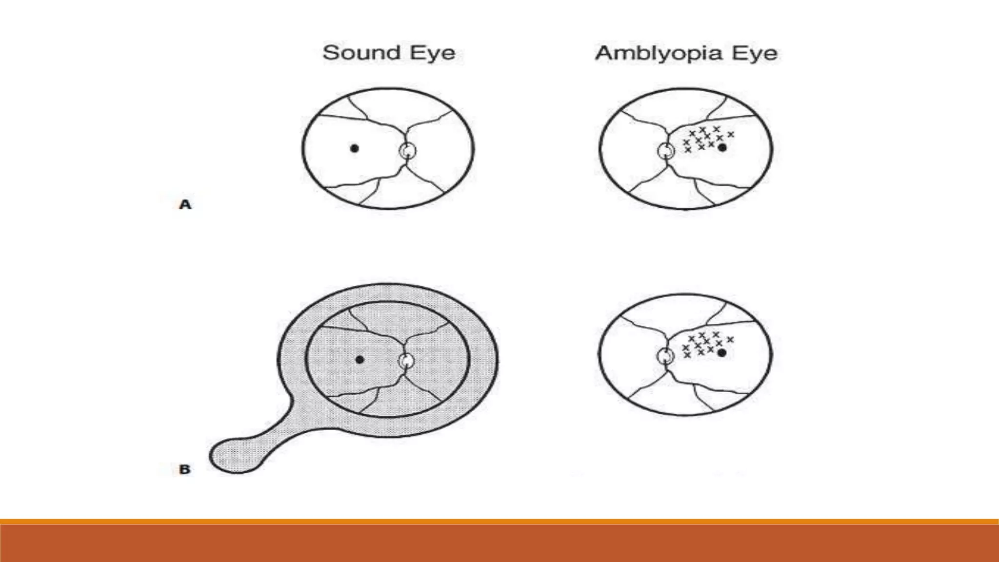 Amblyopia : classification & Occlusion therapy | PPTX