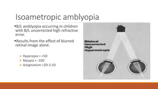 Amblyopia : classification & Occlusion therapy | PPTX