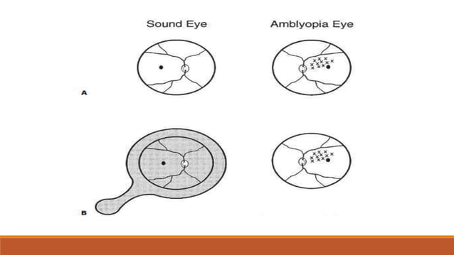 Amblyopia : classification & Occlusion therapy | PPTX | Eye and Vision ...
