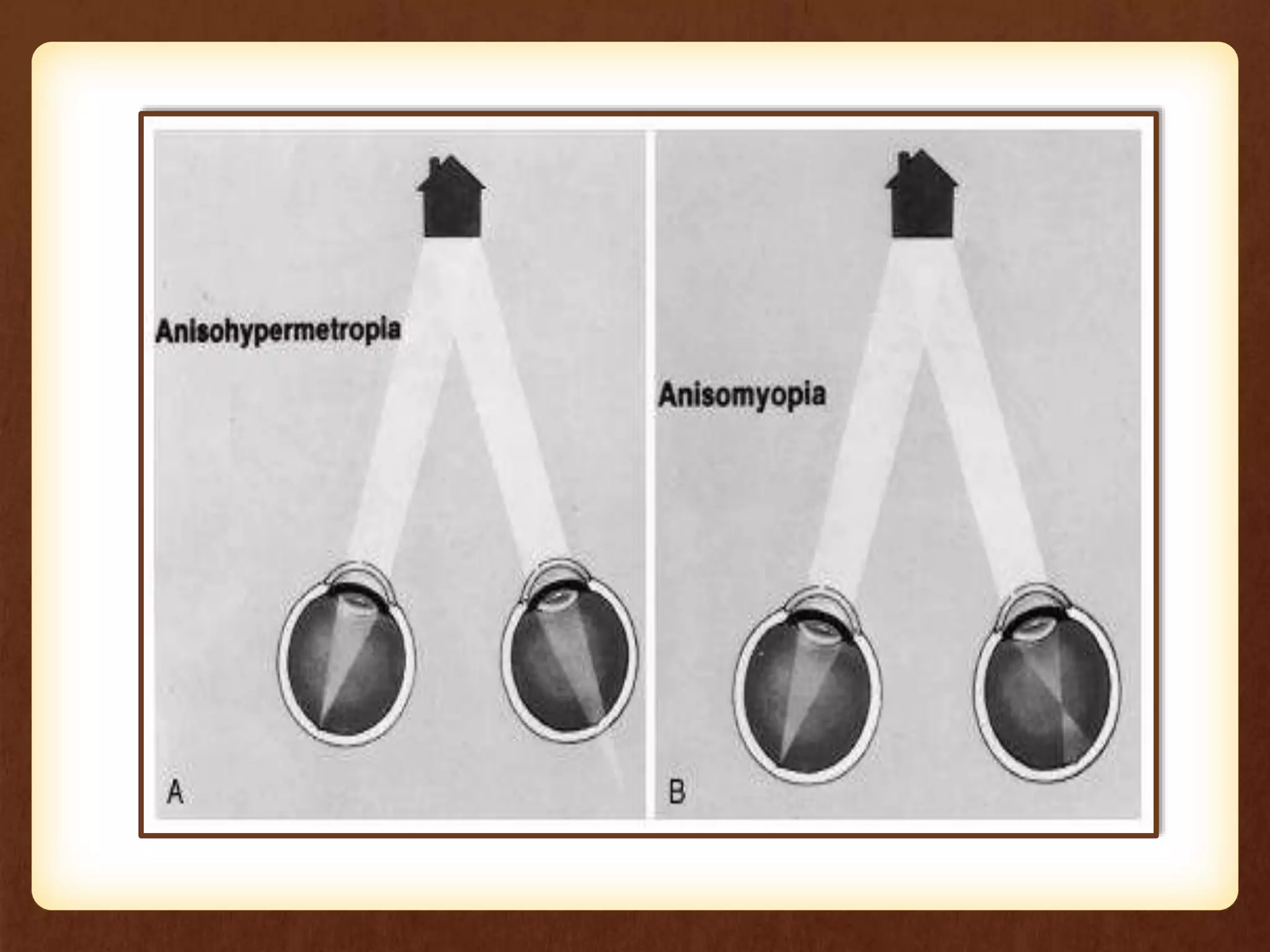 AMBLYOPIA AND ITS MANAGEMENT | PPTX