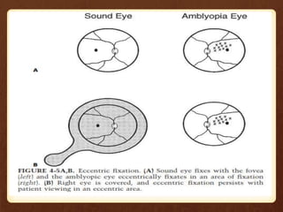 AMBLYOPIA AND ITS MANAGEMENT | PPTX