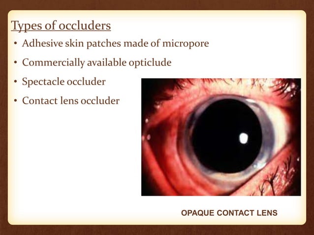 AMBLYOPIA AND ITS MANAGEMENT