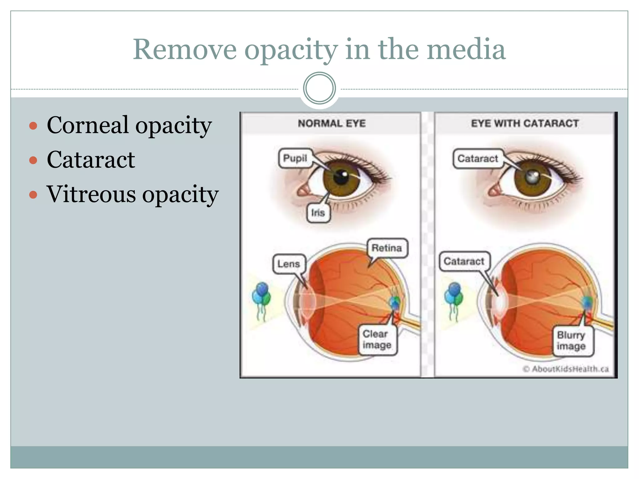 Amblyopia (lazy eye) | PPTX