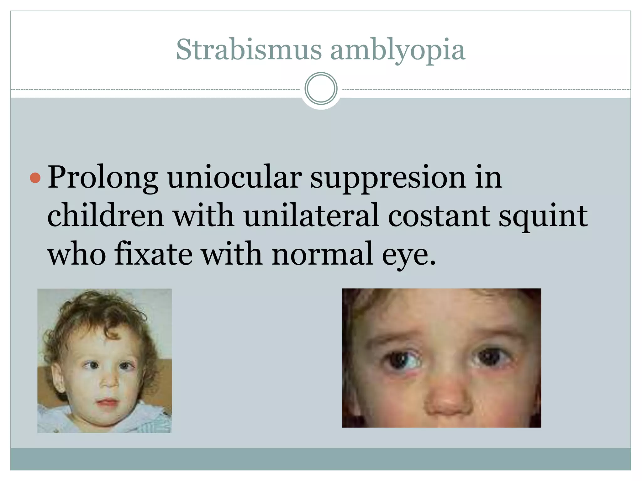 Amblyopia (lazy eye) | PPTX