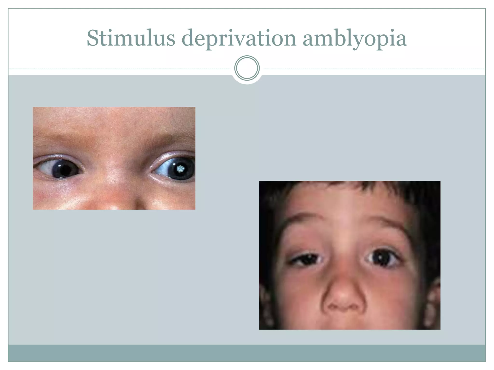 Amblyopia (lazy eye) | PPTX