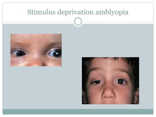 Amblyopia (lazy eye) | PPTX